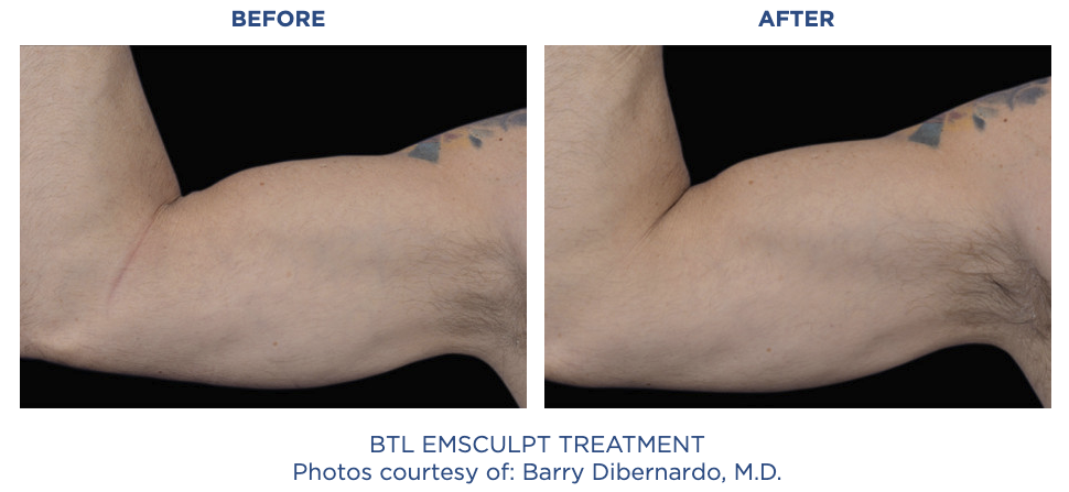 Before & After – Emsculpt Laguna
